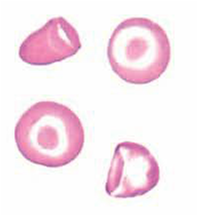 Celulas Sanguineas: Atlas de hematología: Anormalidades serie eritroide.