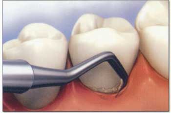 Dentistry and Medicine: Efficacy of Root Planning