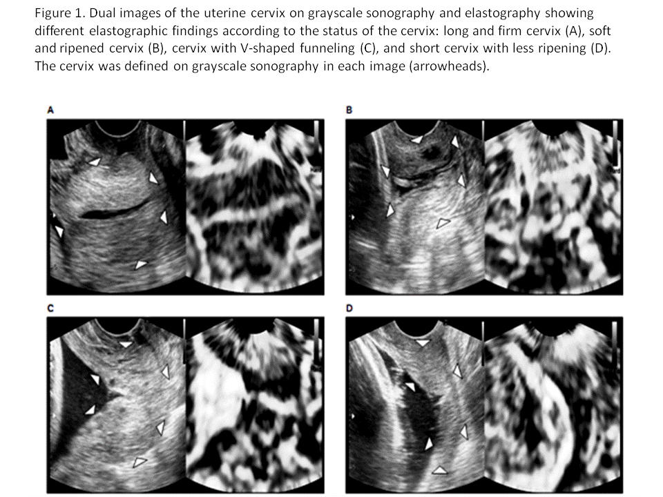 BÀI SOẠN VỀ SIÊU ÂM CHẨN ĐOÁN: Cervical Elastography for Prediction of ...