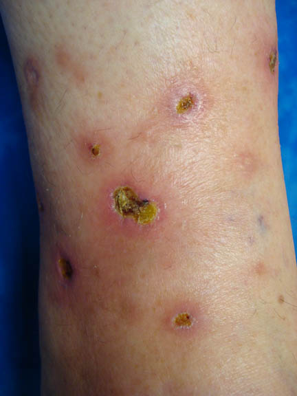 VIRTUAL GRAND ROUNDS IN DERMATOLOGY 2.0: 65 yo woman with nodulo ...