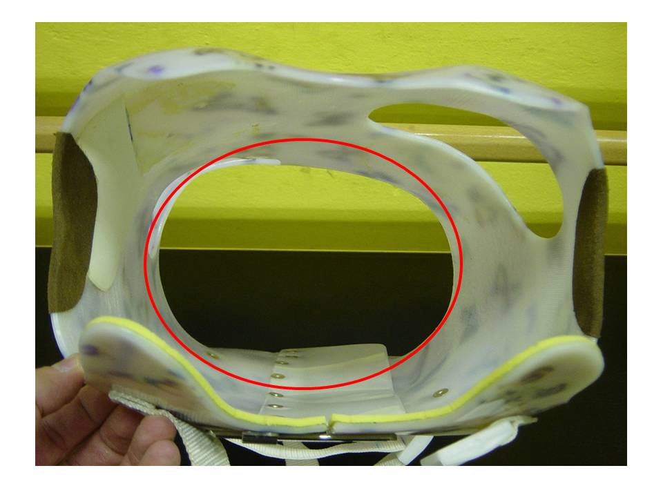 Despre corsetul Cheneau :: Corset scolioza / scoliosis braces