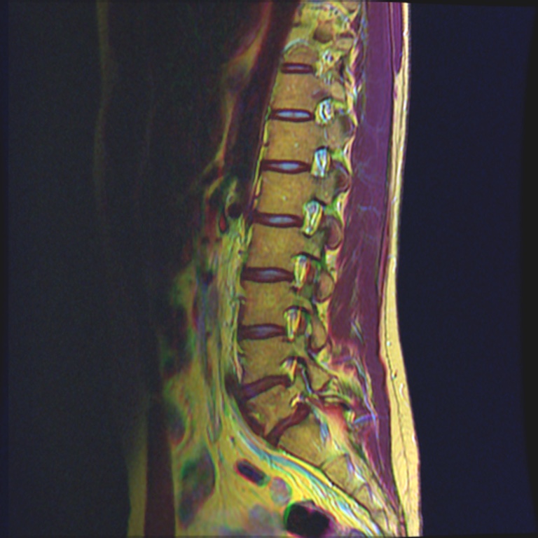 Nevit's blog: Color MRI of the vertebral column