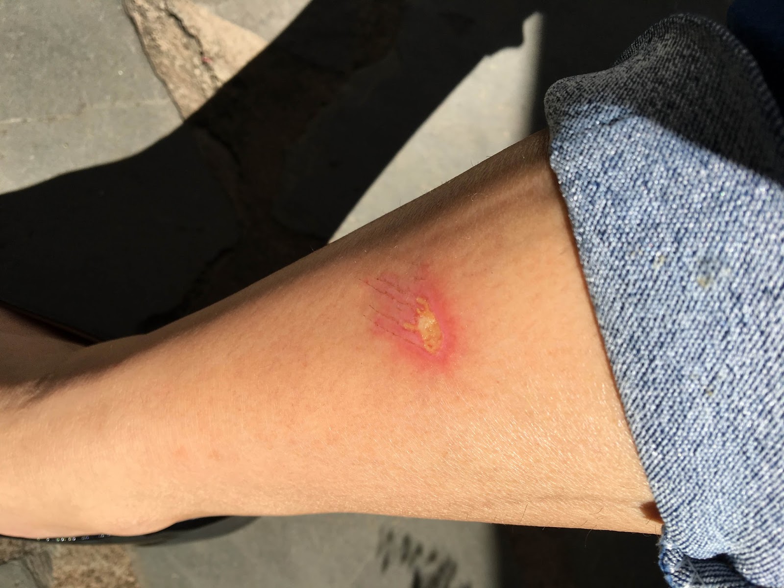 Machucados em diabéticos - Template Holiday