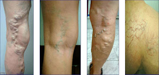 Viva bem com a vida !: Varizes