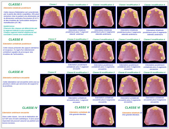 Odonto Lovers: Clasificación de Kennedy