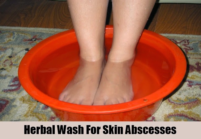5 HERBAL REMEDIES FOR SKIN ABSCESSES ~ Mzizi Mkavu