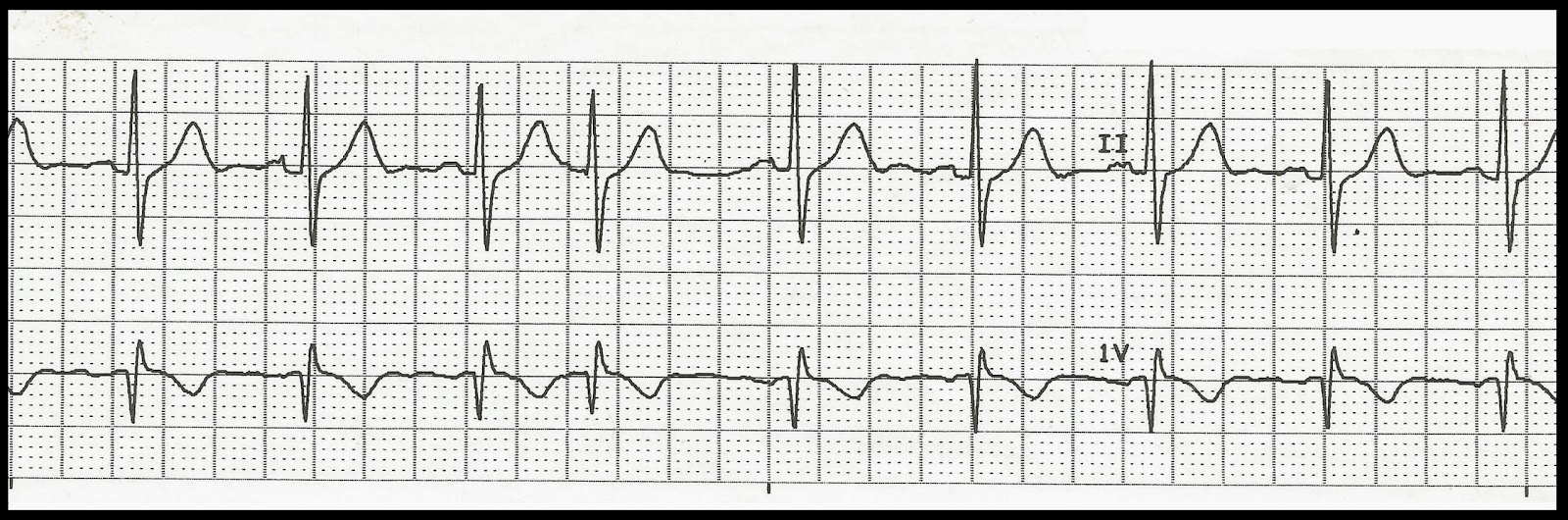 Practice EKG Rhythm Strips 220