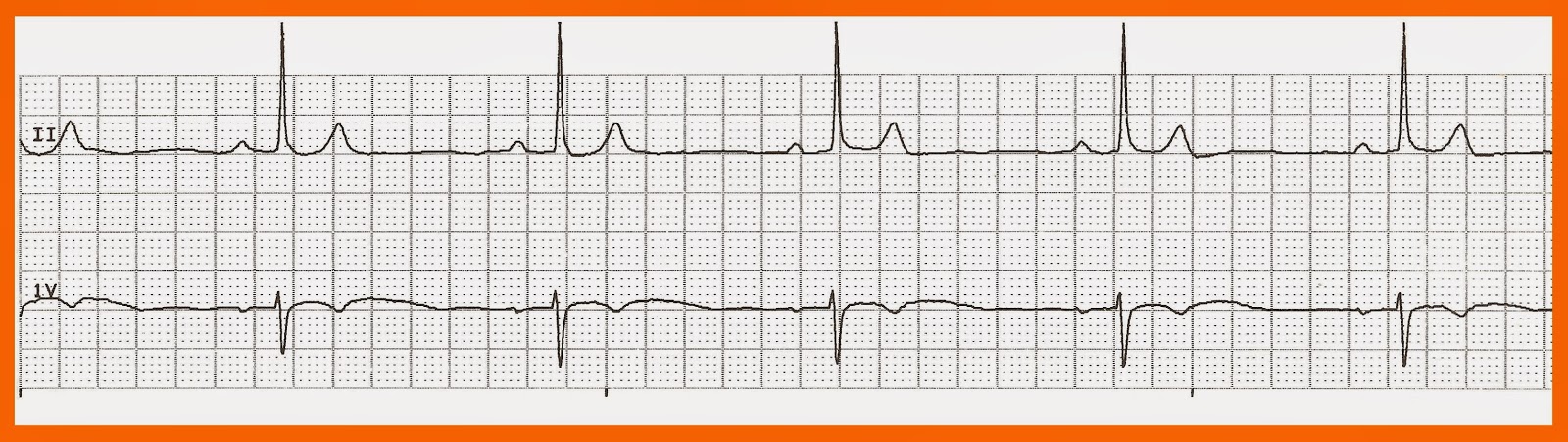 Practice EKG Strips 384