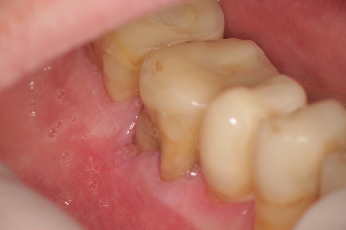 Patrick Baltieri: Dente 46 - EXODONTIA ou RETRATAMENTO?