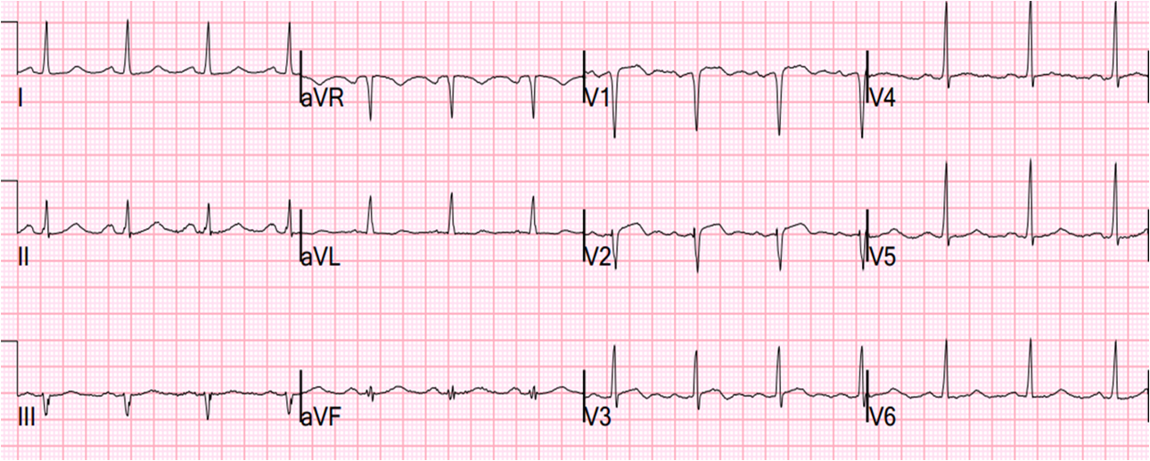 Dr. Smith's ECG Blog: Septal STEMI with lateral ST depression, then has ...