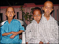 progeria cases in india ~ Christine O'Donnell