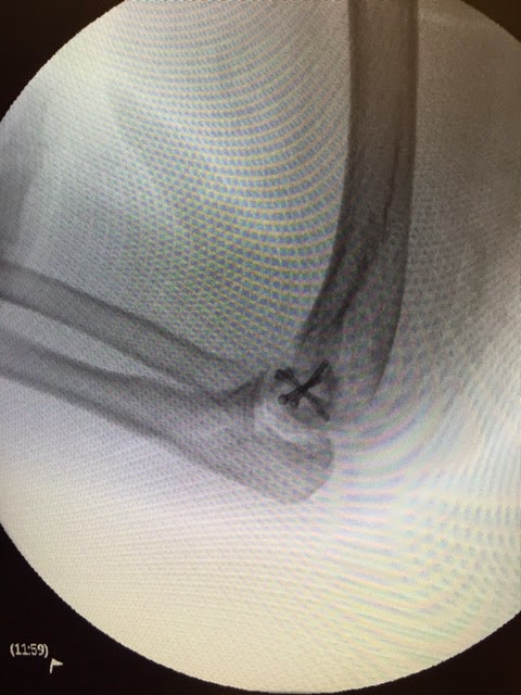 Shoulder and Elbow Surgery: Shear fractures of the capitellum.