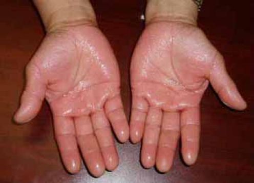 Online Pharmacy: Diseases of sweat glands