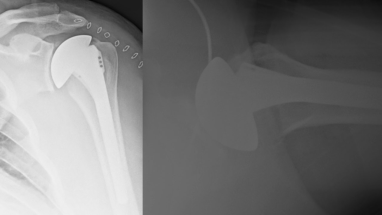 Shoulder and Elbow Surgery: Shoulder resurfacing, hemi-arthroplasty or ...