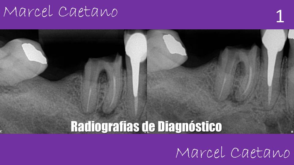 Endodontia Avançada: Anatomia radicular como fator dificultante para ...