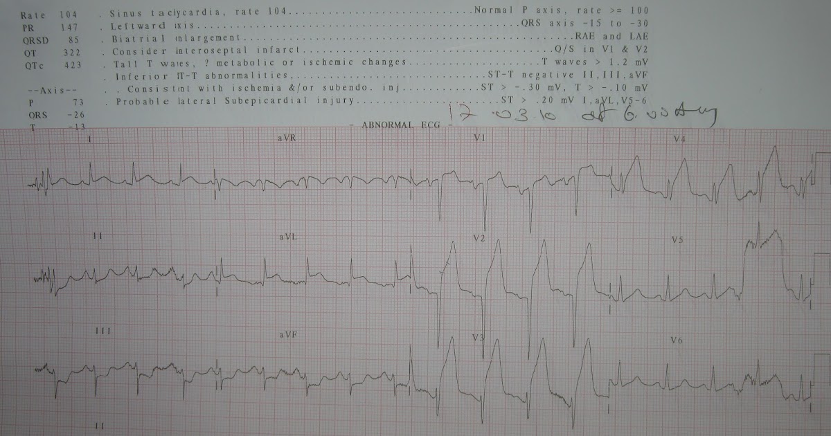 Medical Images Gallery: Anterior Wall MI ECG : ECG changes before and ...