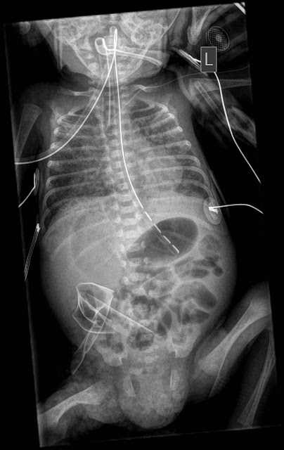 Neonate with abdominal distension