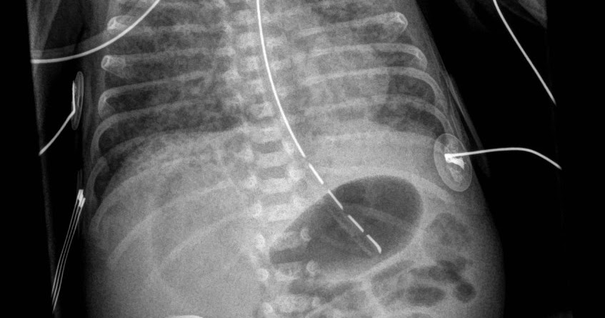 Neonate with abdominal distension
