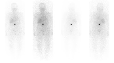 NuCleaR MuNkeE: I-131 Uptake Post Therapy