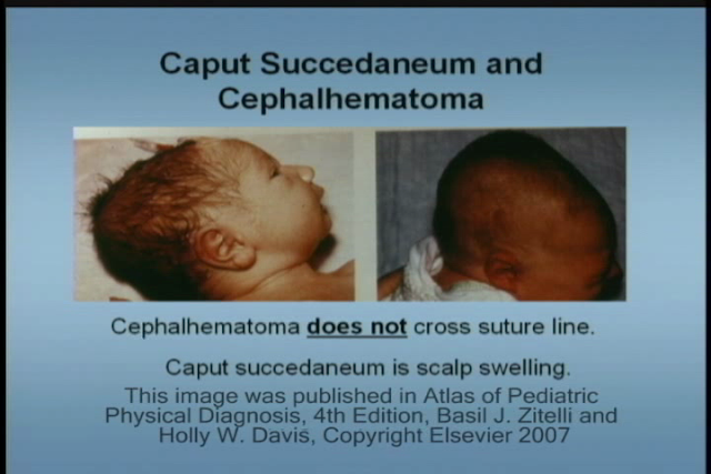 Knowledge Is Power: Caput Succedaneum And Cephalhematoma