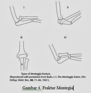 LAPORAN PENDAHULUAN FRAKTUR ANTEBRACHII
