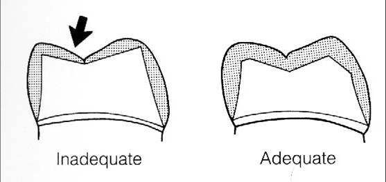 FUNCTIONAL CUSP BEVEL ~ Welcome To Dental lecture Class