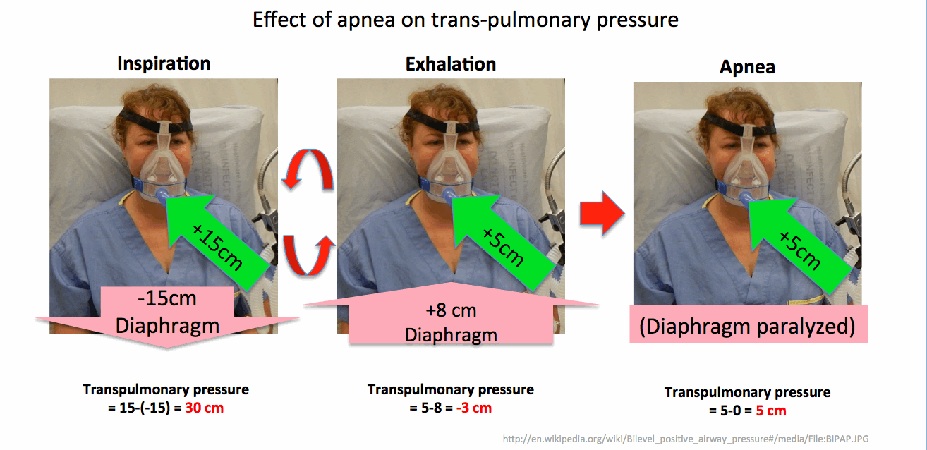 Apneic ventilation using pressure-limited ventilation
