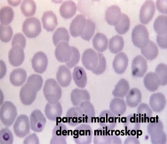 Diagnosa Penyakit Malaria - Terapi Sehat : Info Kesehatan Medis dan ...