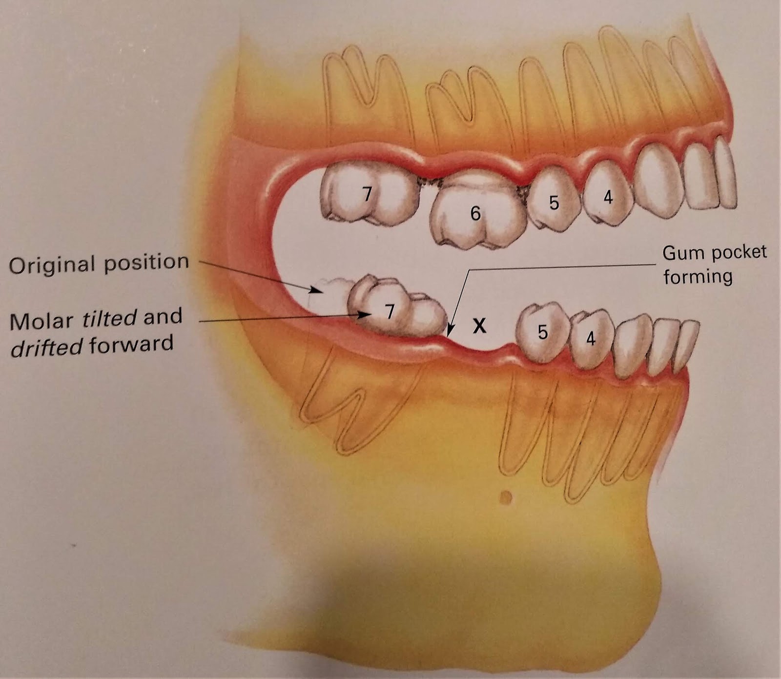 Why should you replace missing teeth? IMPORTANCE OF REPLACING MISSING ...