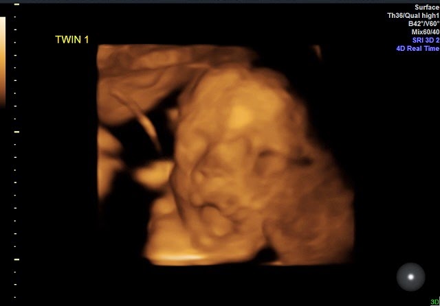 Olive Dragonfly: 3D baby scan - Babyscanning Glasgow review