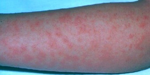 Scarlatina Rash Pictures | Medical Pictures and Images - (2023 Updated)