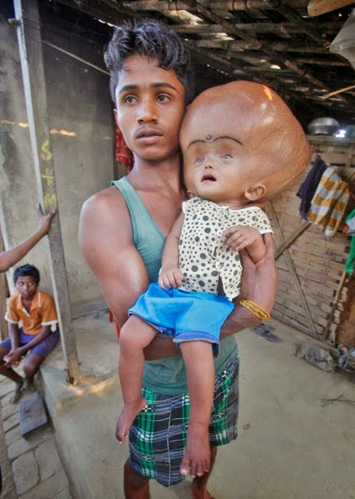 Sonh4dores: Bebê com a maior cabeça do mundo faz cirurgia para redução