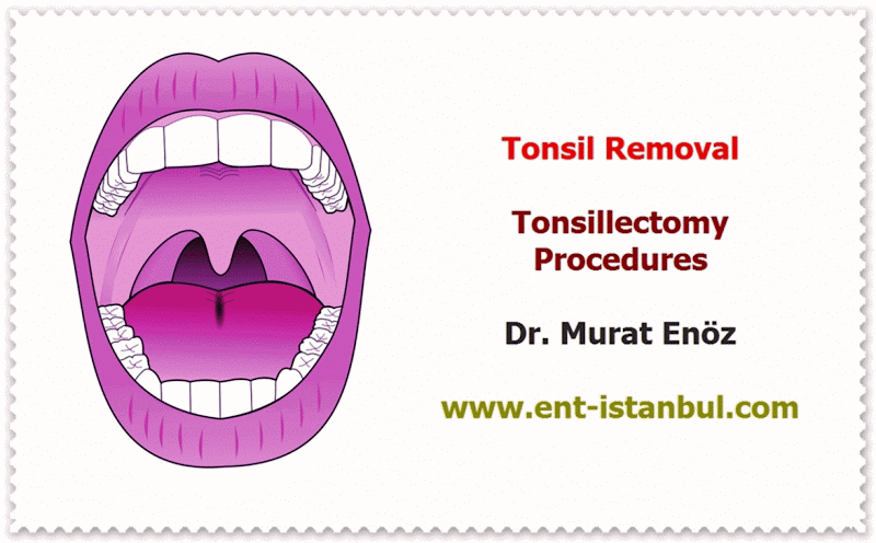 Tonsil Cancer - Causes, Symptoms, Diagnosis and Treatment