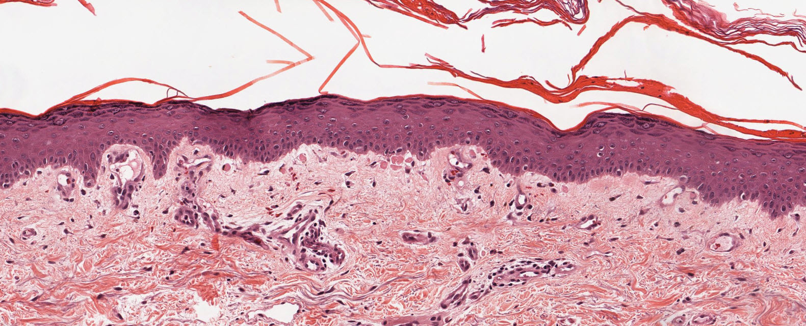 Dermoscopy Made Simple: LPLK