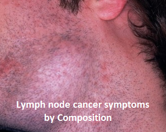 mesothelioma and cancer: 15 Symptoms of Cancer Lymph Nodes by Composition