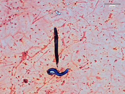 Fun With Microbiology (What's Buggin' You?): Strongyloides stercoralis ...