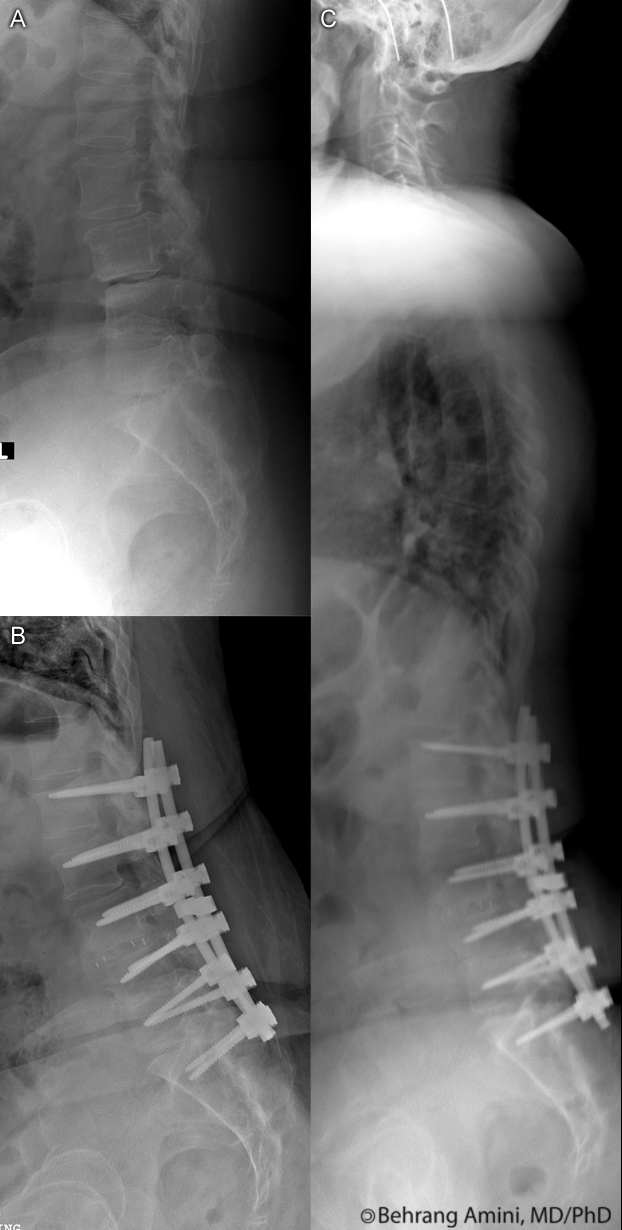 Roentgen Ray Reader: Sagittal Balance and the Flat Back Syndrome