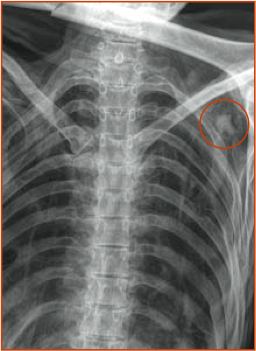 Ötzi - The Iceman: How was the Iceman Killed? ; Changing ...