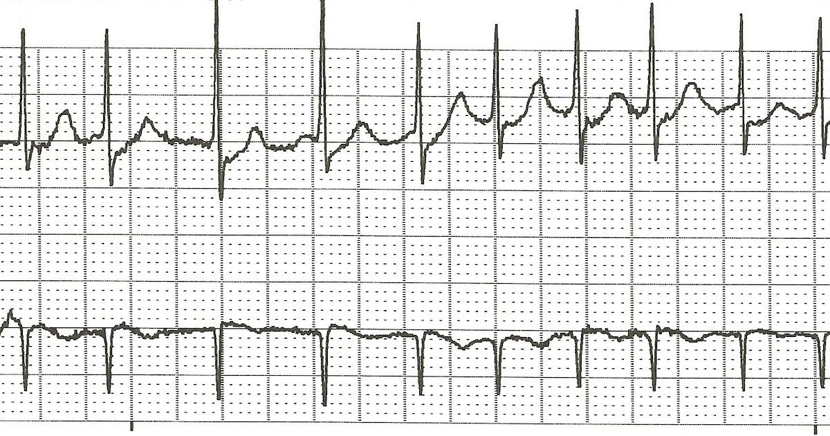 Float Nurse: New Onset Atrial Fibrillation Part 1