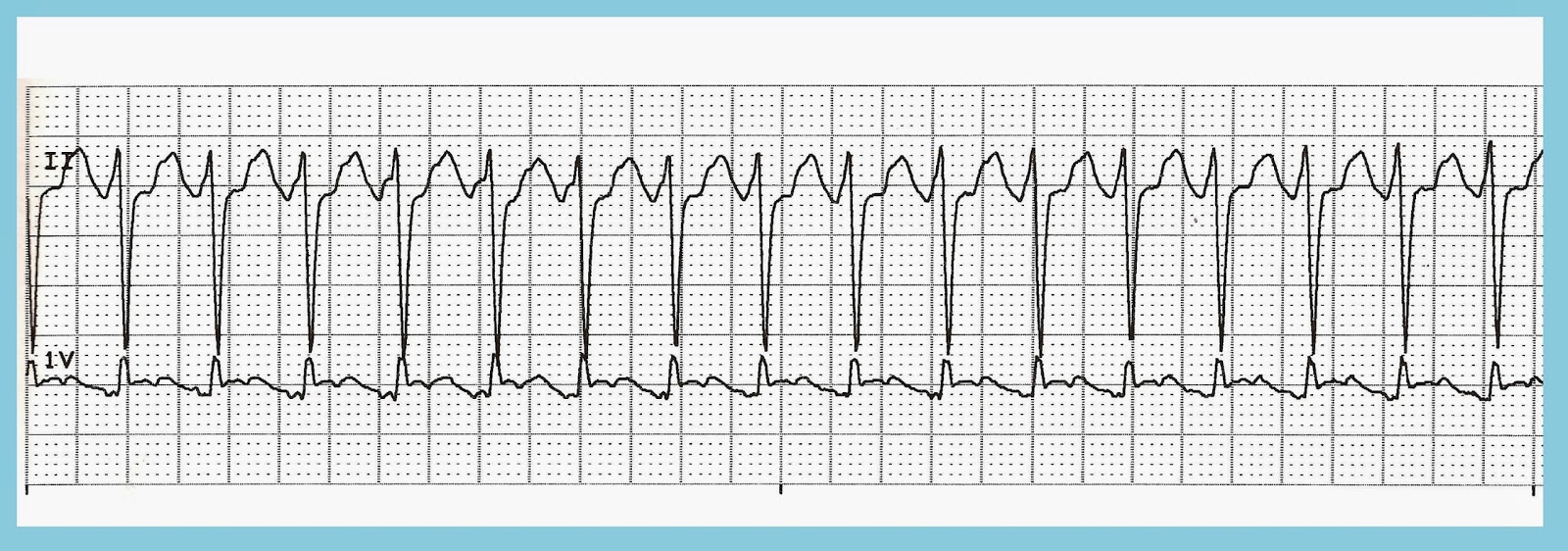 Practice Rhythm Strips 290