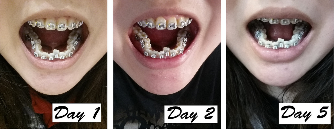 Stay Happy☆*: Braces Journey Part 1