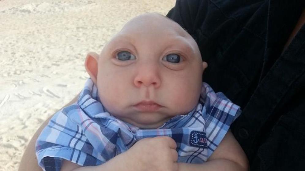 La Historia De Superación Del Niño Jaxon El Bebé Que Nació Sin Parte