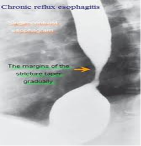 AMBITIOUS MEDICAL TEAM: Esofagitis Korosif