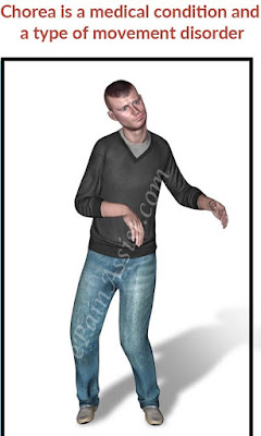 Choreiform Gait Physiotherapy Mx - PHYSIO STUDY