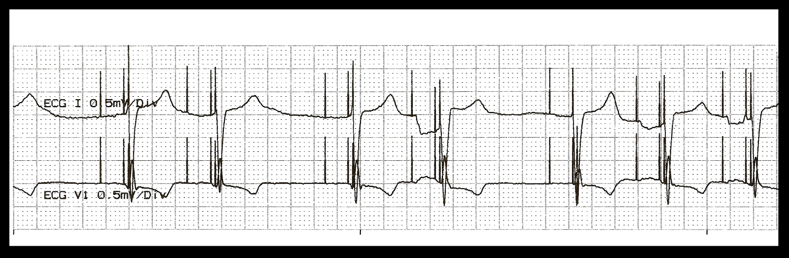 Various Dual Paced Rhythms