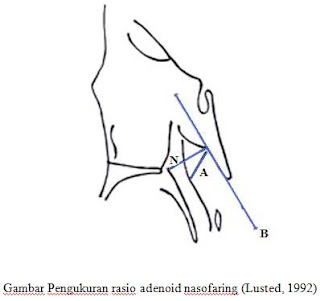 ANATOMI: Rasio Adenoid Nasofaring