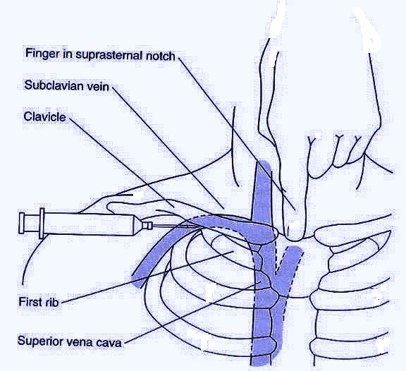 Emergency Medicine. A free ebook online.: Peripheral and central venous ...