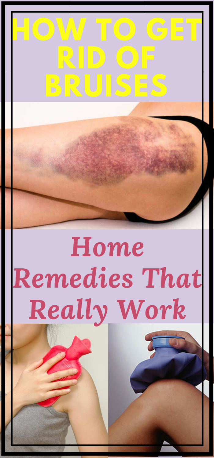 Run Healthy Lifestyle: How To Get Rid Of Bruises: Home Remedies That ...