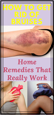 Run Healthy Lifestyle: How To Get Rid Of Bruises: Home Remedies That ...