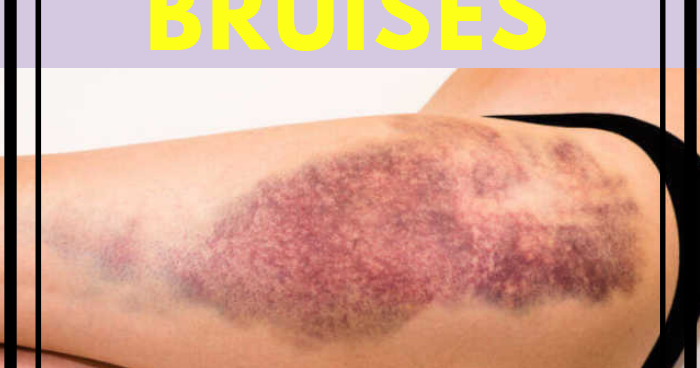 Run Healthy Lifestyle: How To Get Rid Of Bruises: Home Remedies That ...